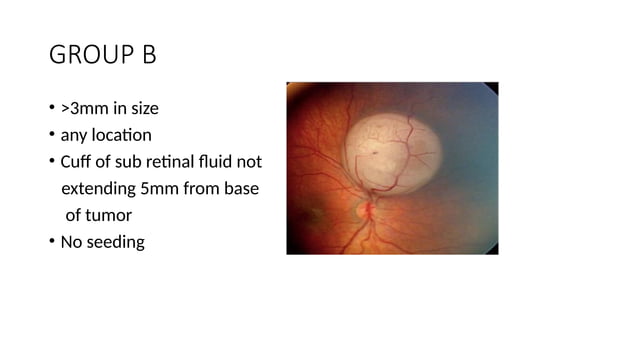 RETINOBLASTOMA - clinical features, etiology, doagnosis and management ...