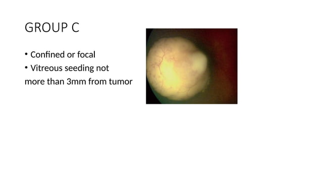 RETINOBLASTOMA - clinical features, etiology, doagnosis and management ...