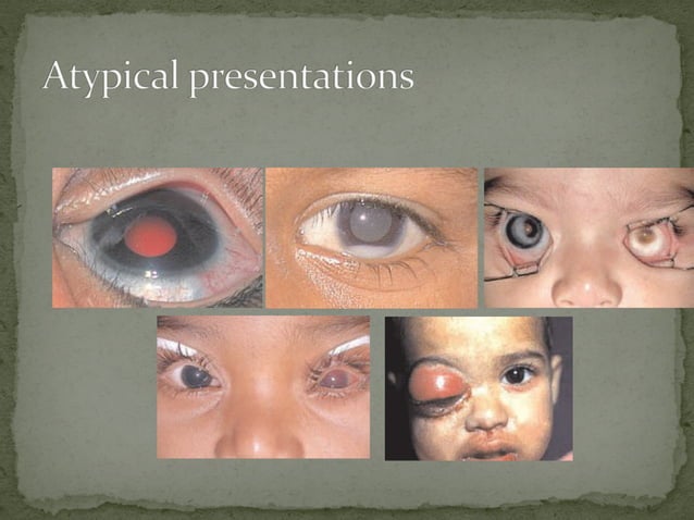 Retinoblastoma | PPT