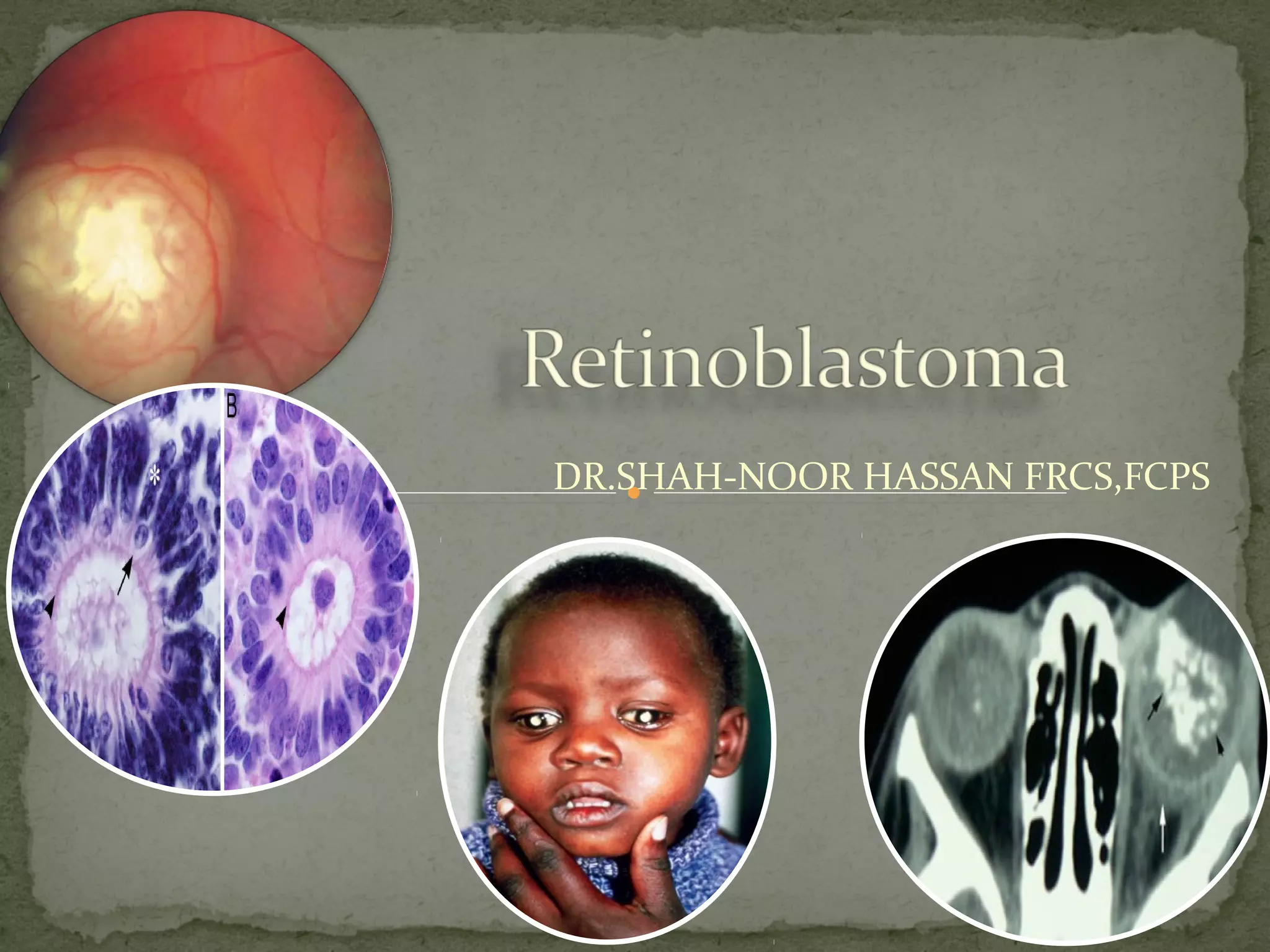 Retinoblastoma (Rb) | PPT