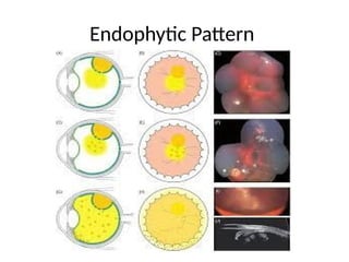 RETINOBLASTOMA prresentation.pptx endophytic and exophytic ...