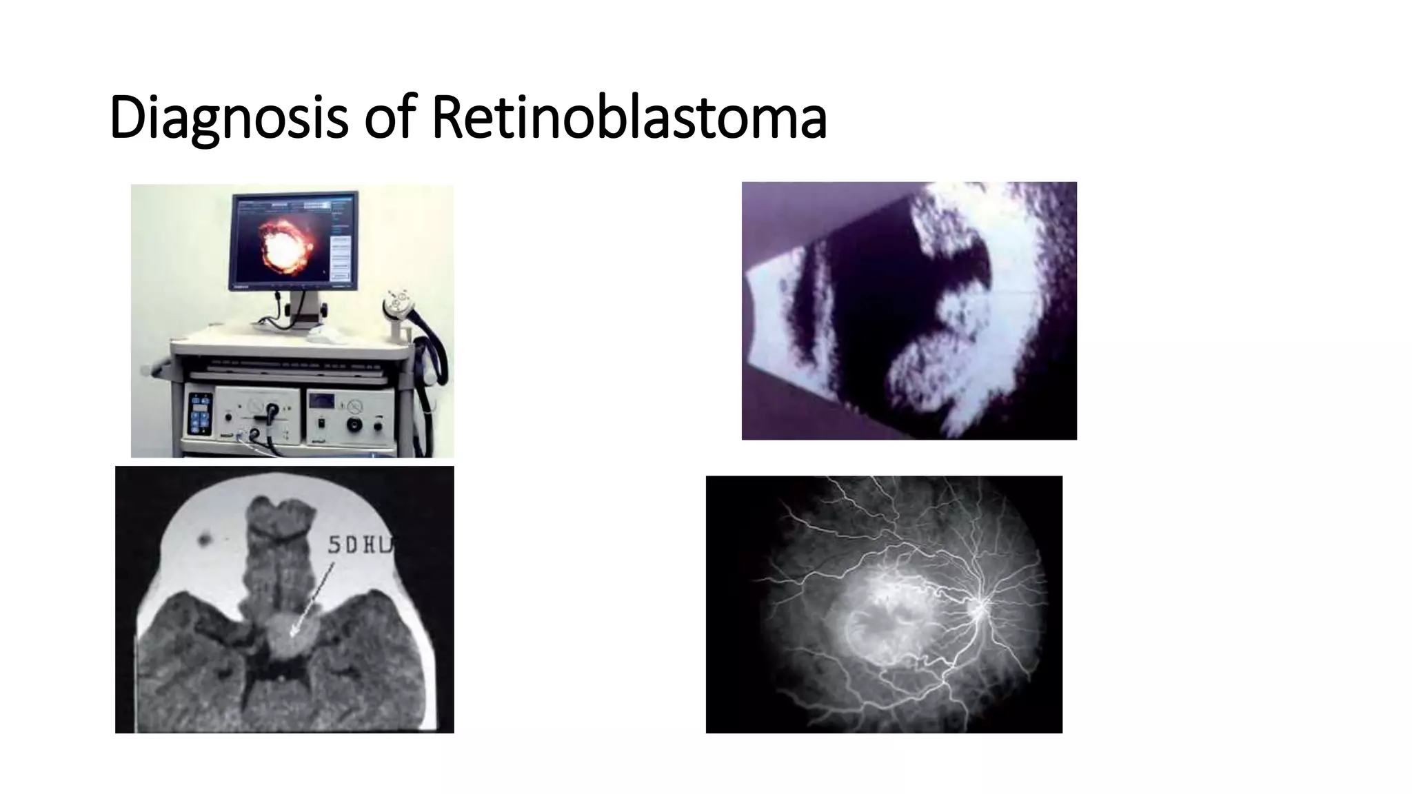 Retinoblastoma | PPTX
