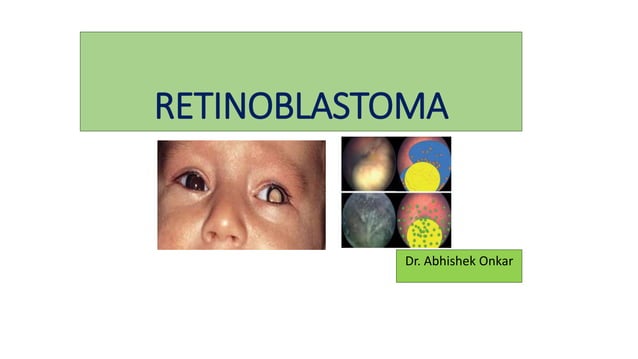 Retinoblastoma | PPTX | Eye and Vision Conditions | Diseases and Conditions