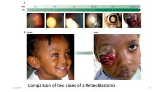 Retinoblastoma | PPT