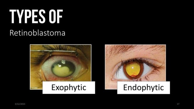 Retinoblastoma