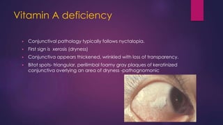 Retinoic acid and ocular surface | PPTX