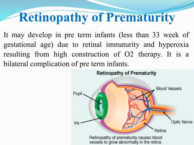 Retinopathy of Prematurity | PDF