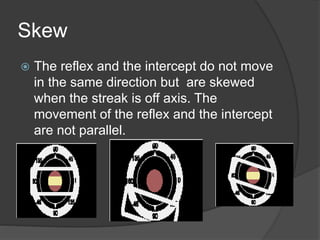 Retinoscopy For Astigmatism | PPTX