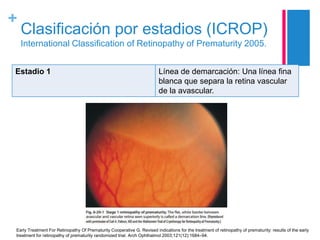 Retinopatía del prematuro | PPTX