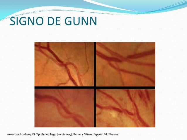 Retinopatía hipertensiva
