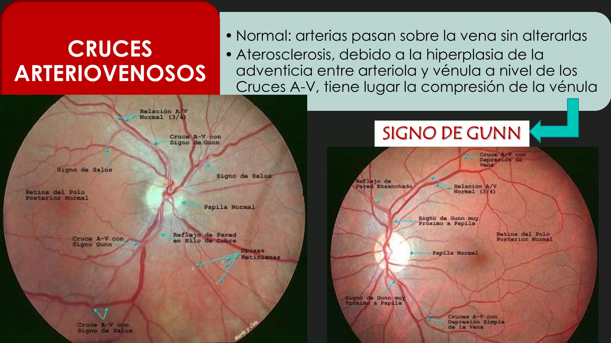 Retinopatía Hipertensiva | PPT