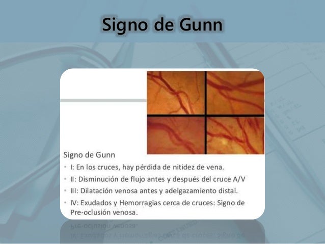 Retinopatía hipertensiva