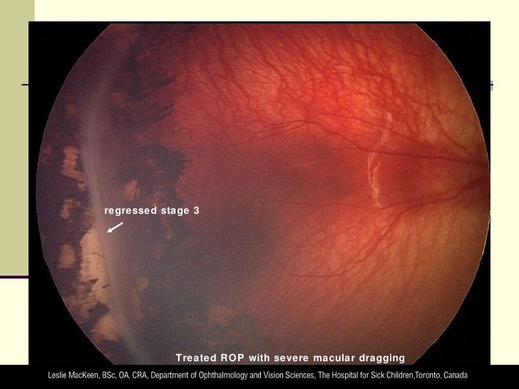 Retinopathy Of Prematurity