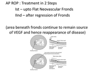 Retinopathy of prematurity | PPTX