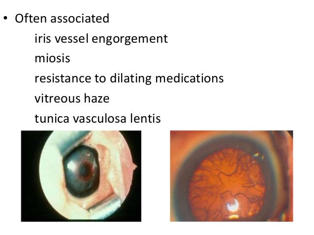 Retinopathy of prematurity