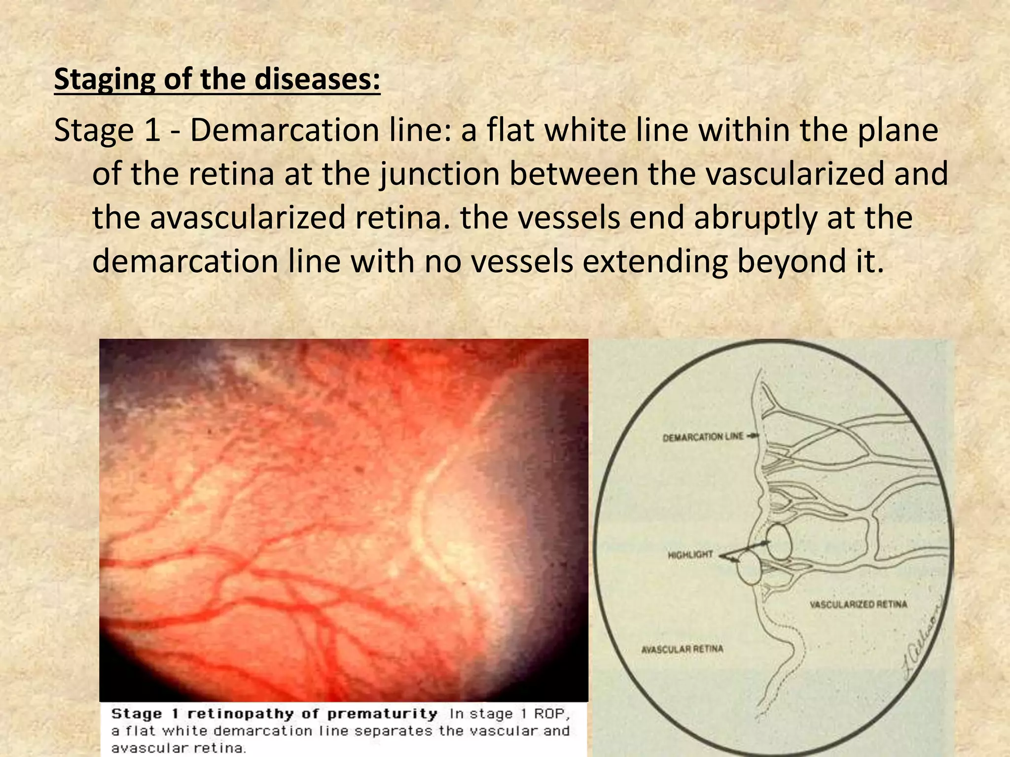 Retinopathy of prematurity | PPTX