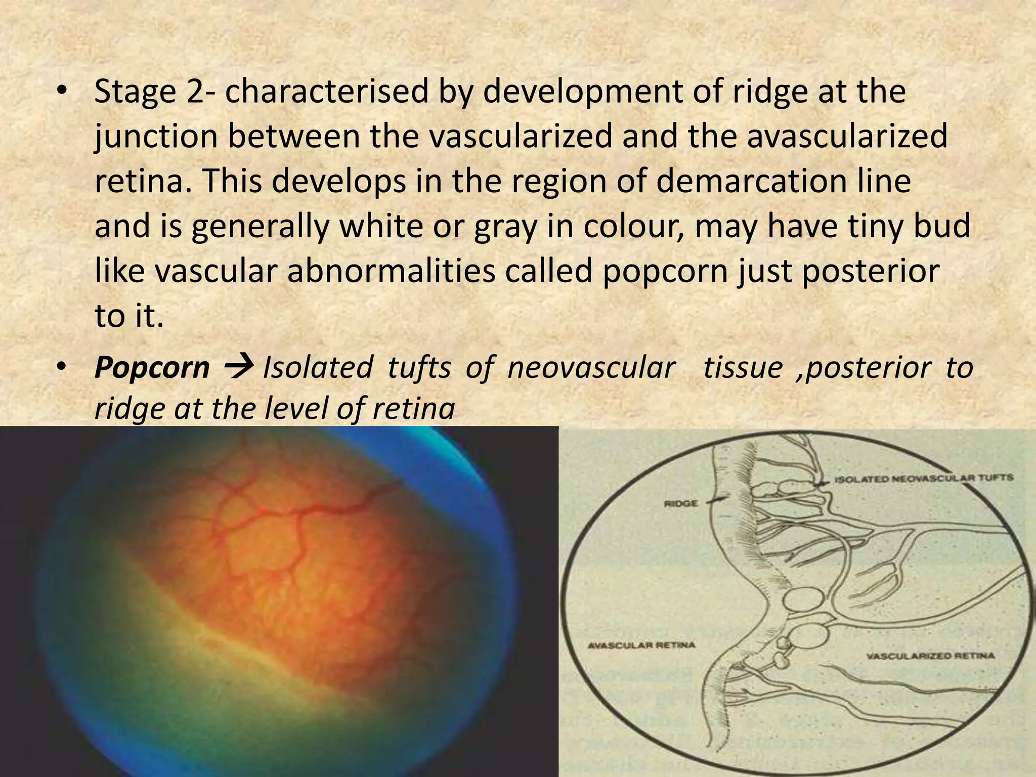 Retinopathy of prematurity | PPTX