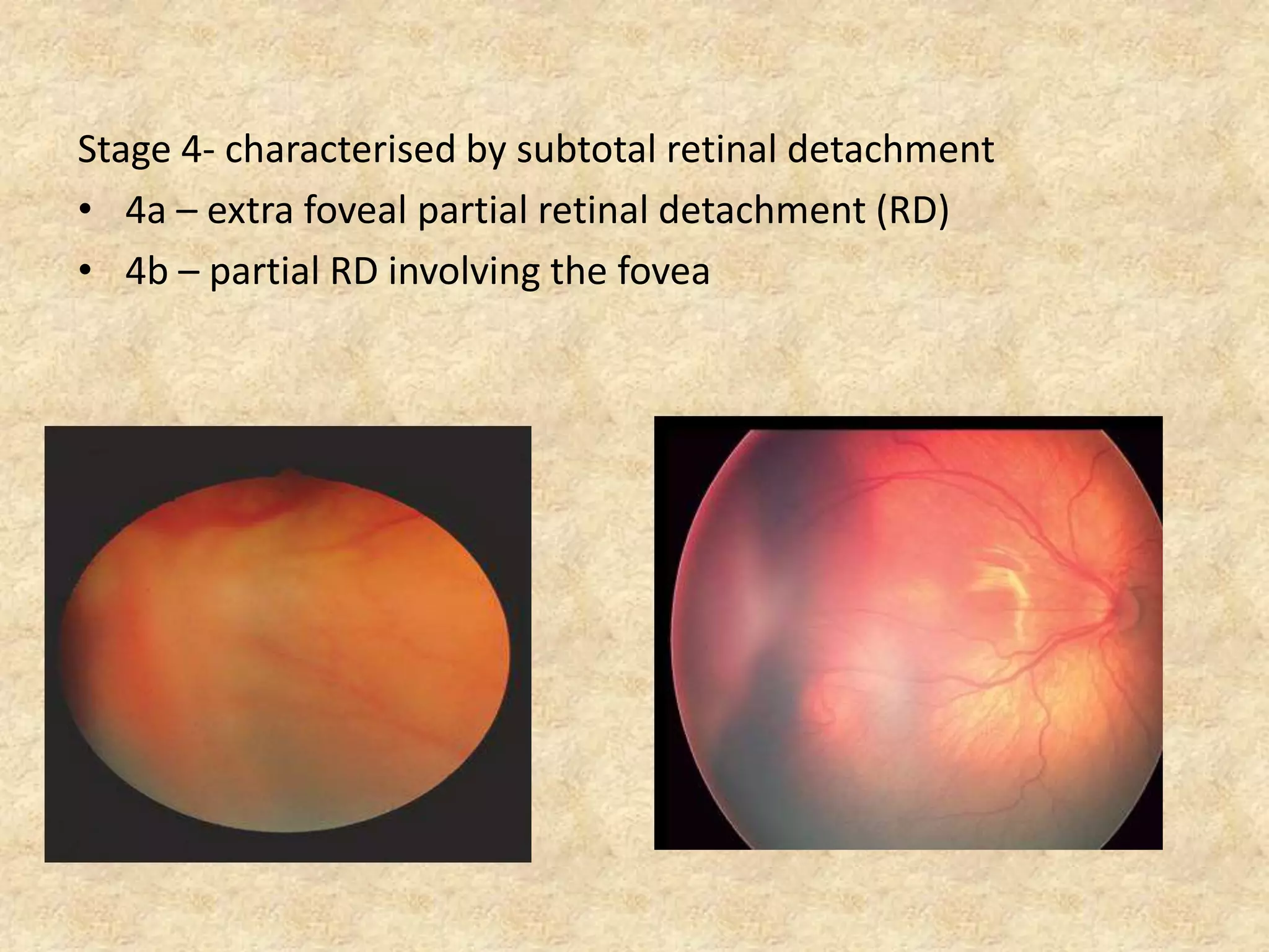 Retinopathy of prematurity | PPTX