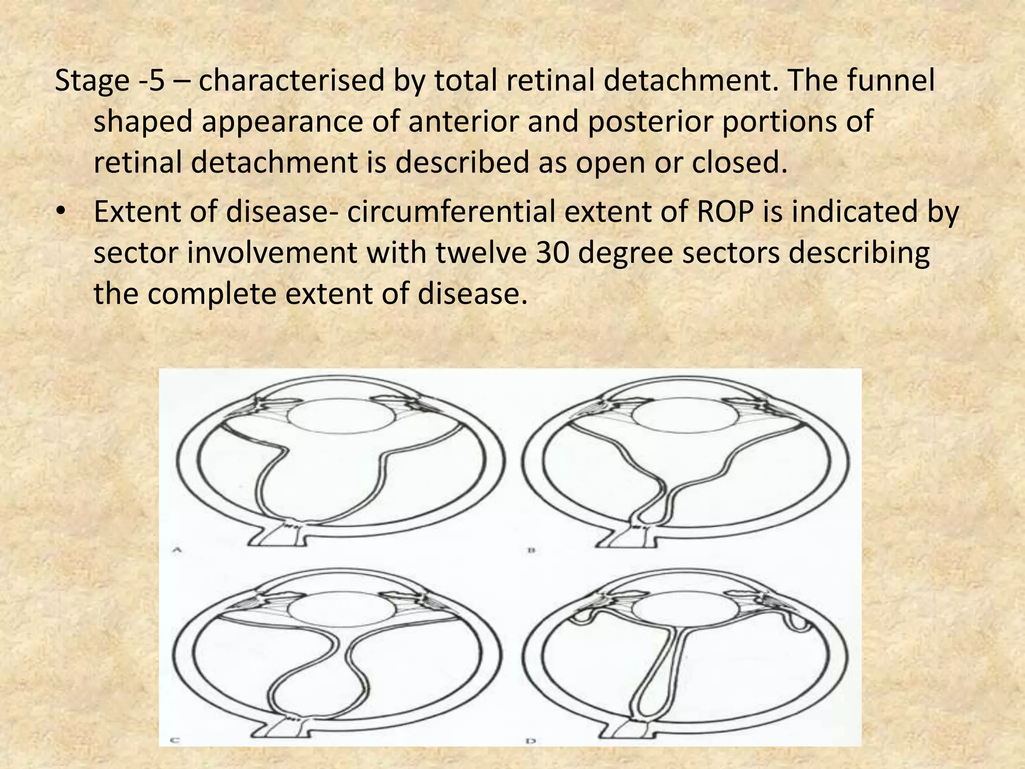 Retinopathy of prematurity | PPTX