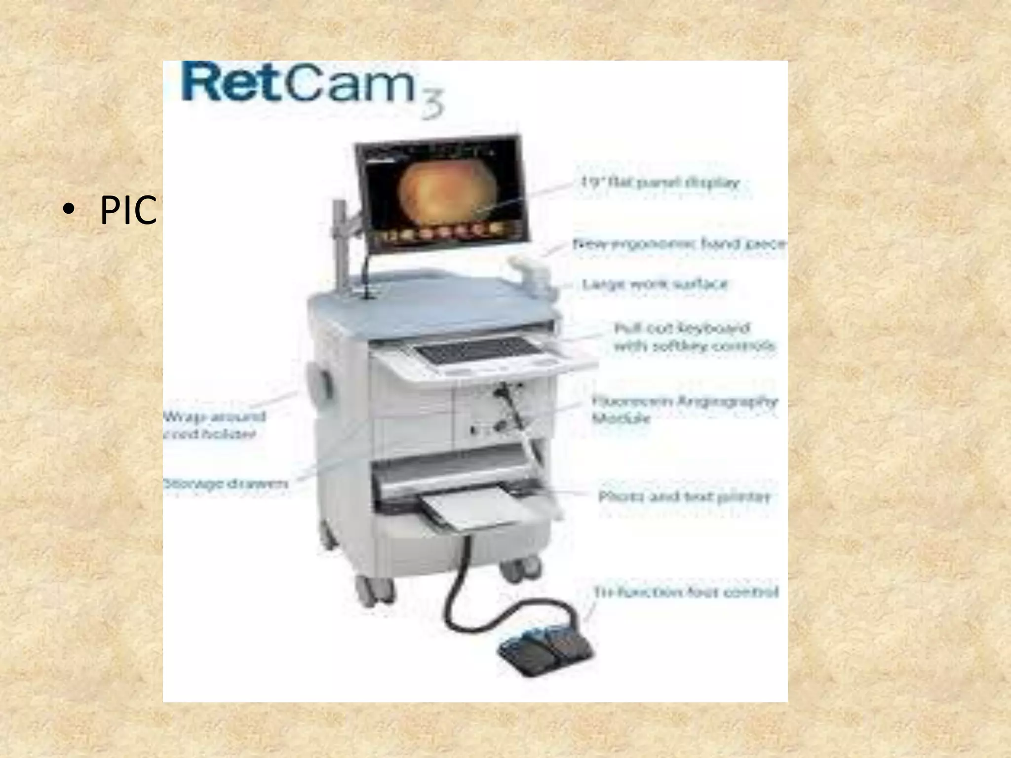 Retinopathy of prematurity | PPTX
