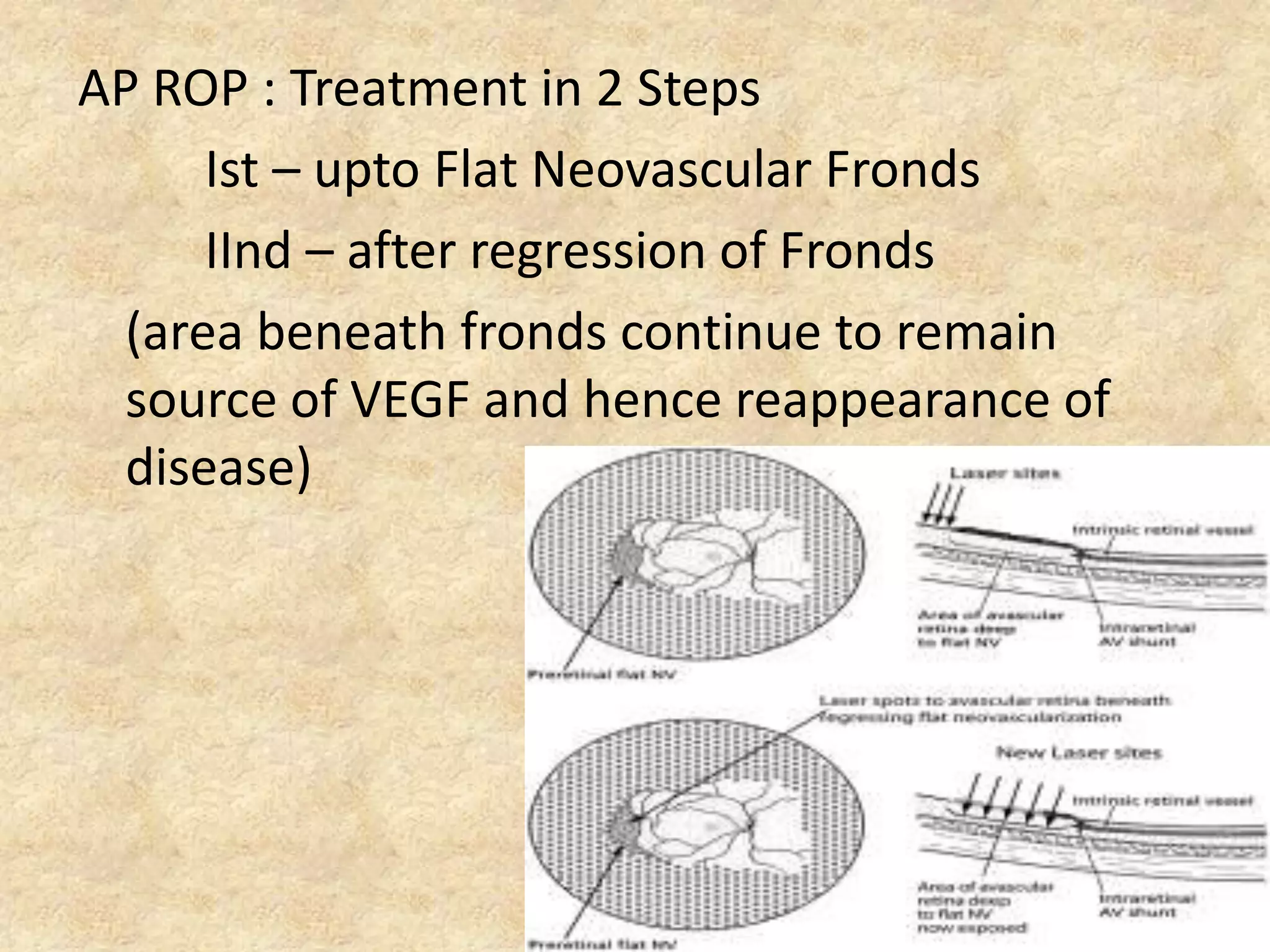 Retinopathy of prematurity | PPTX