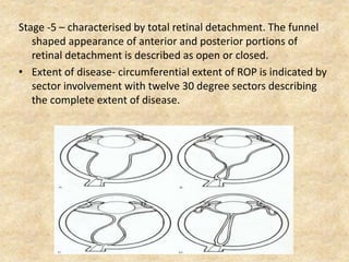 Retinopathy of prematurity | PPTX