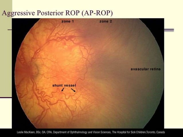 Retinopathy of prematurity | PPTX
