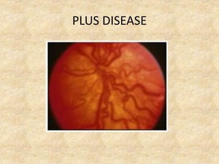 Retinopathy Of Prematurity Plus Disease