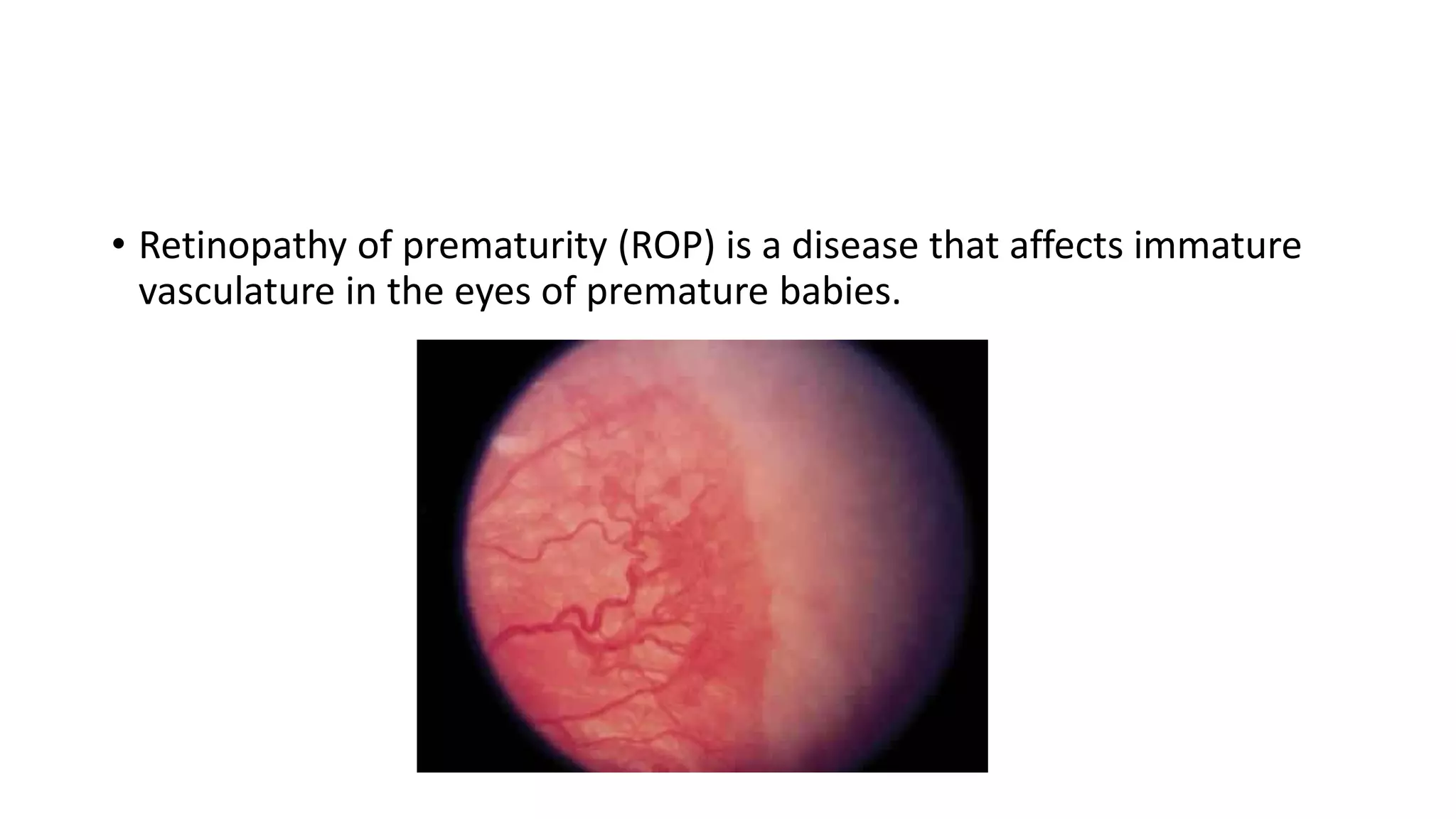 Retinopathy of prematurity | PPTX