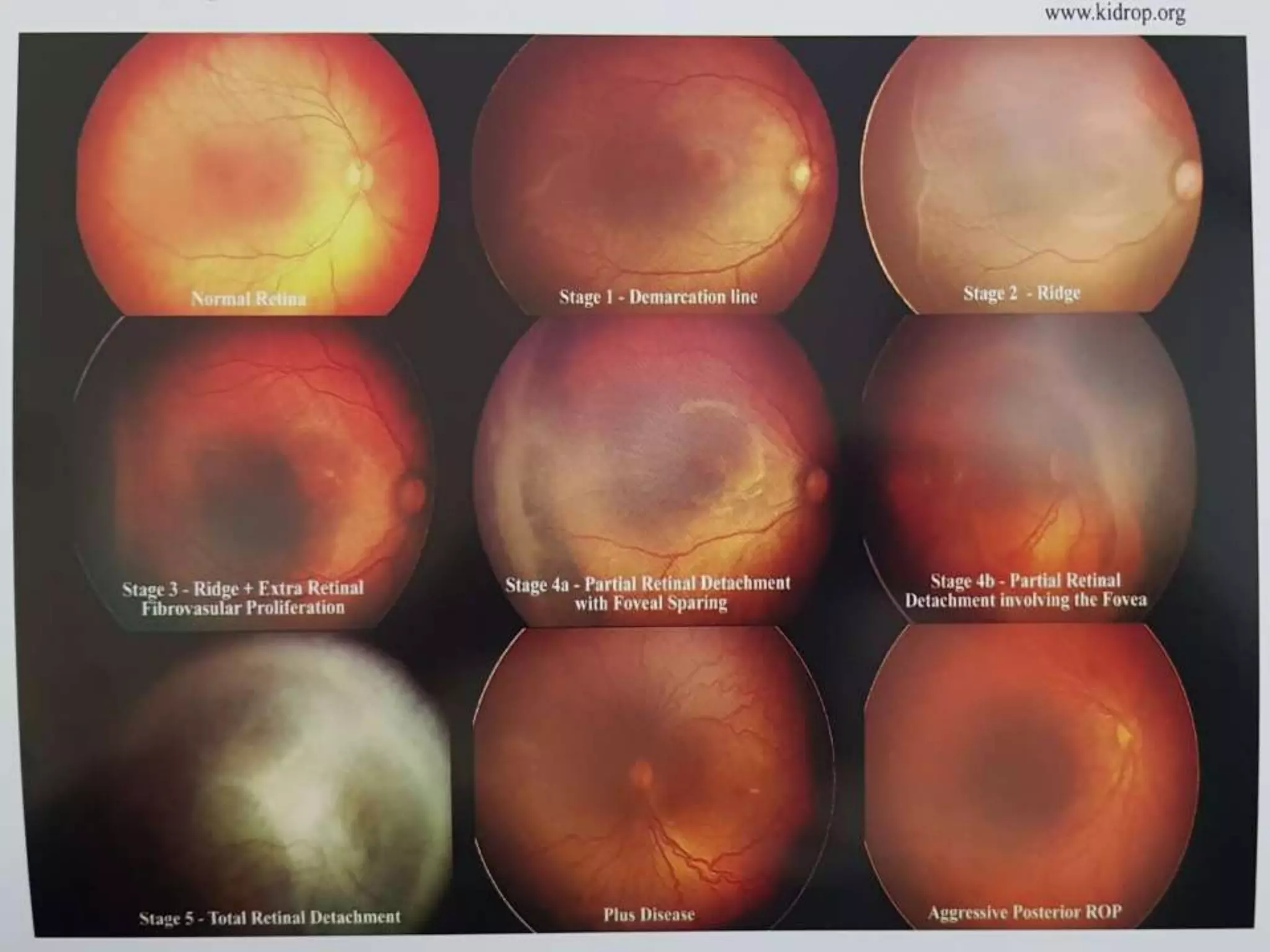 Retinopathy of prematurity | PPTX