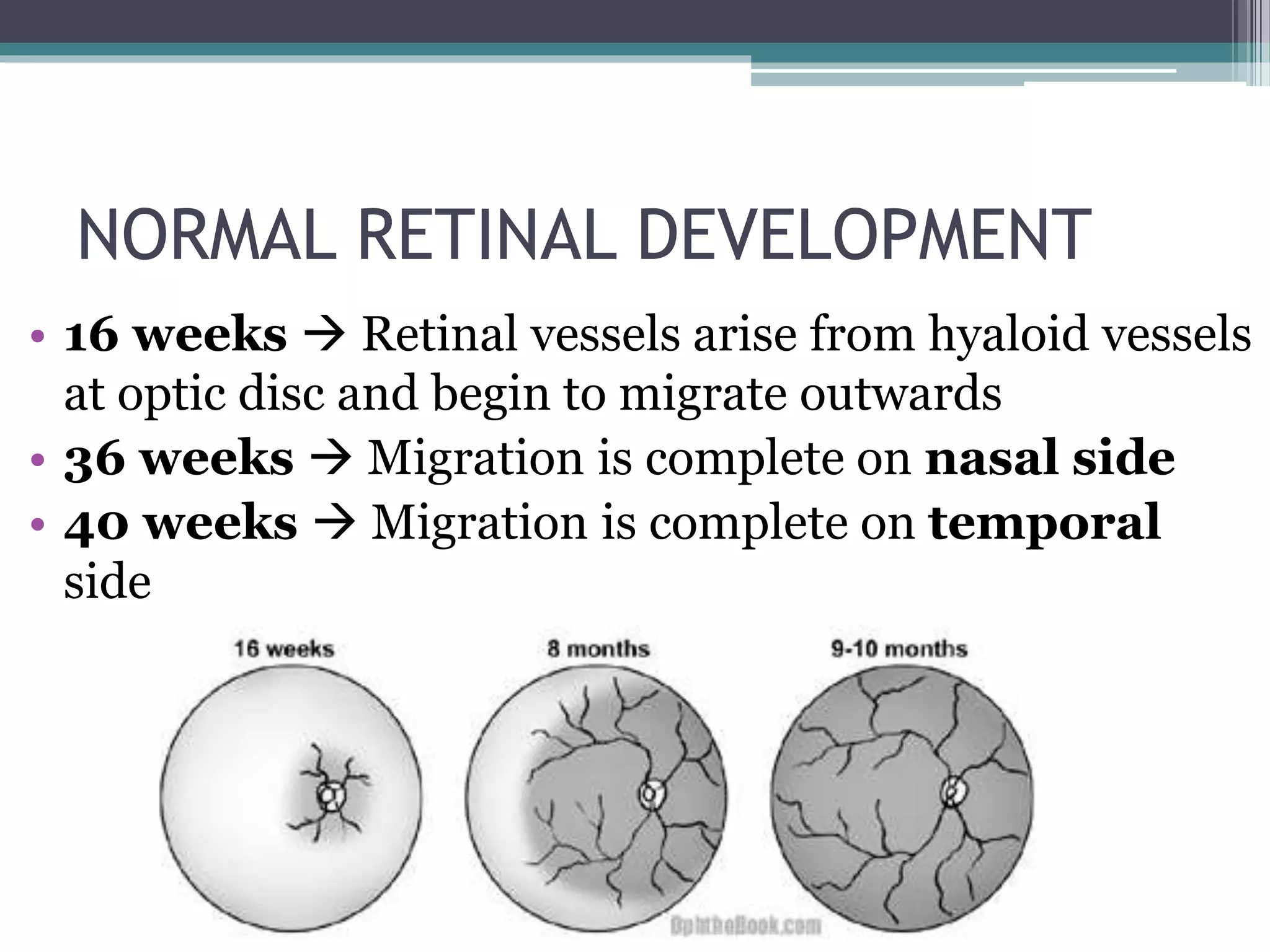 Retinopathy of prematurity | PPTX