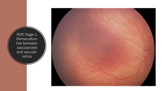 Retinopathy of prematurity | PPTX