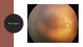 Retinopathy of prematurity | PPTX