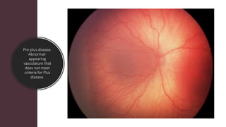 Retinopathy of prematurity | PPTX