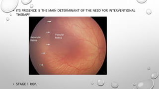 Retinopathy of prematurity | PPTX