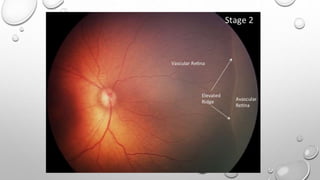 Retinopathy of prematurity | PPTX