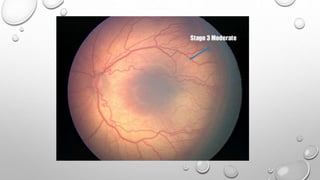 Retinopathy of prematurity | PPTX