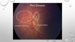 Retinopathy of prematurity | PPTX