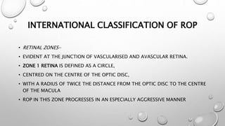 Retinopathy of prematurity | PPT