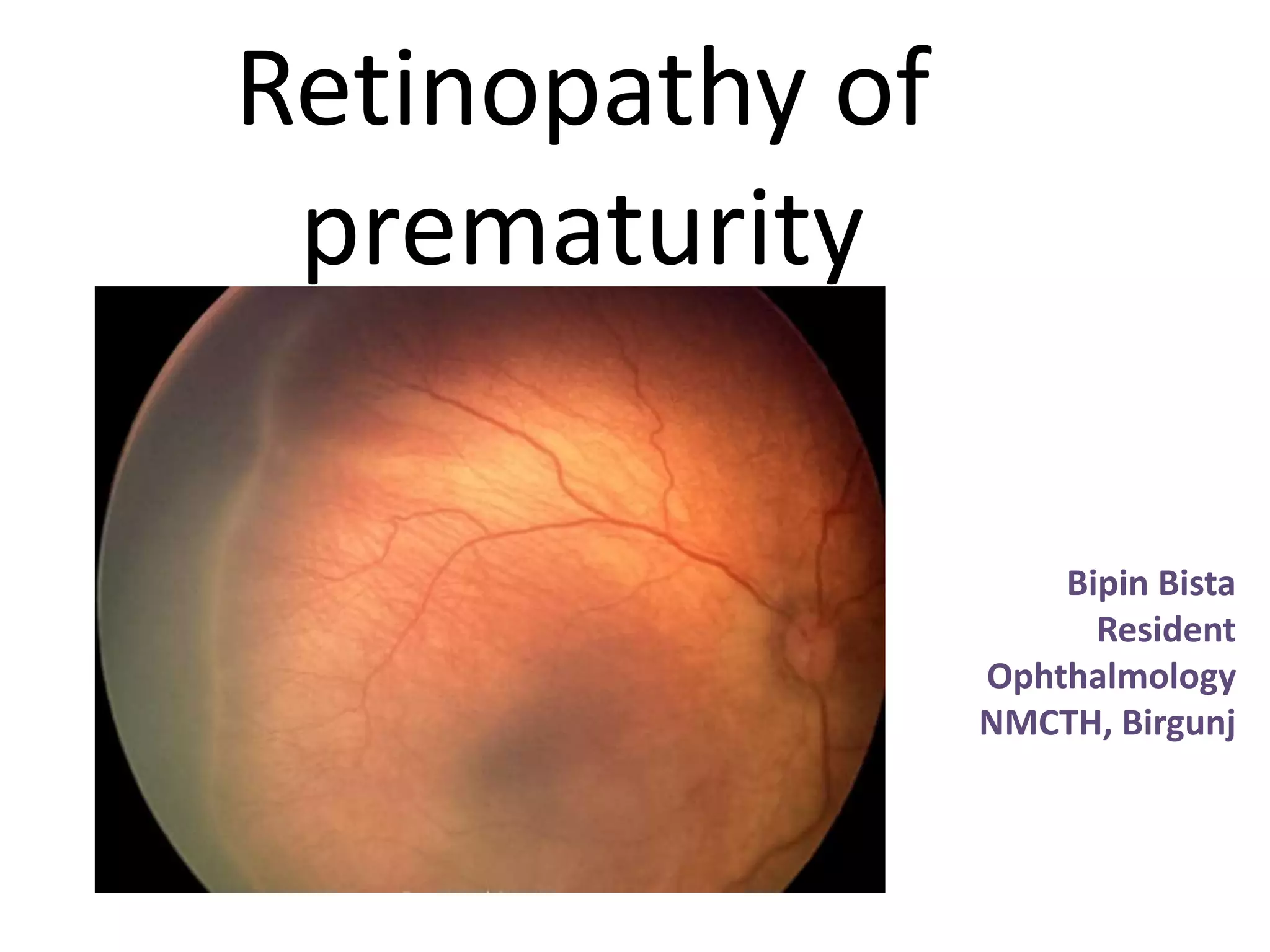 Retinopathy of prematurity | PPTX