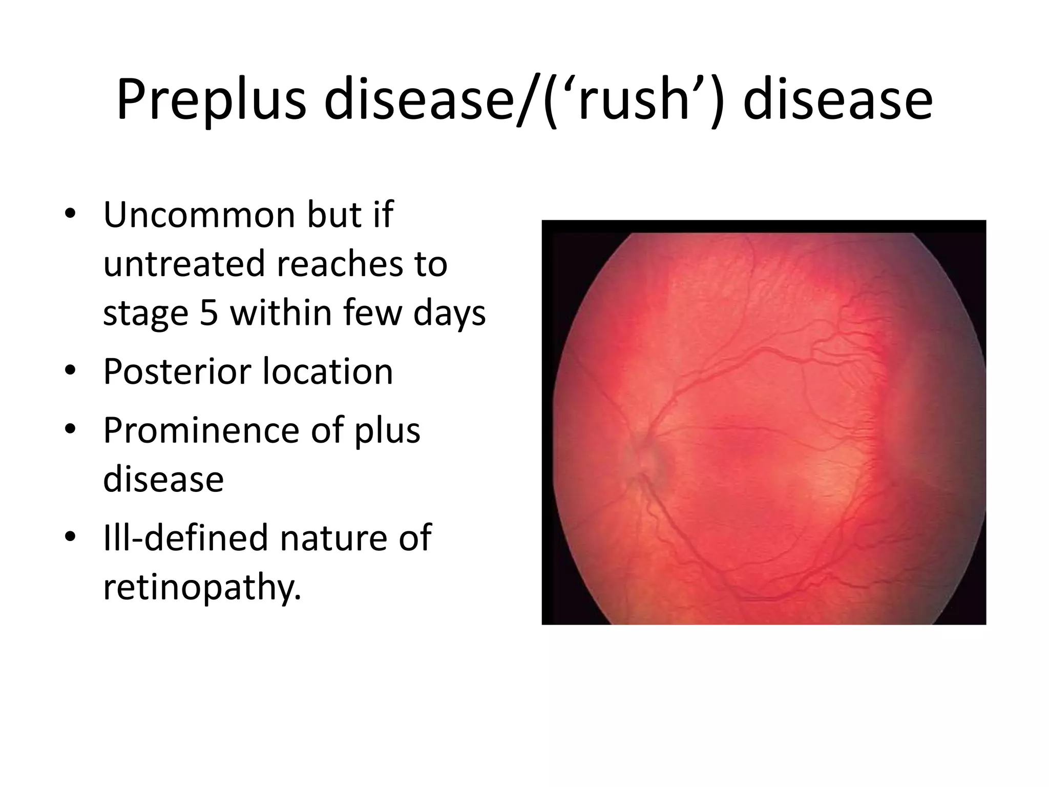 Retinopathy of prematurity | PPTX