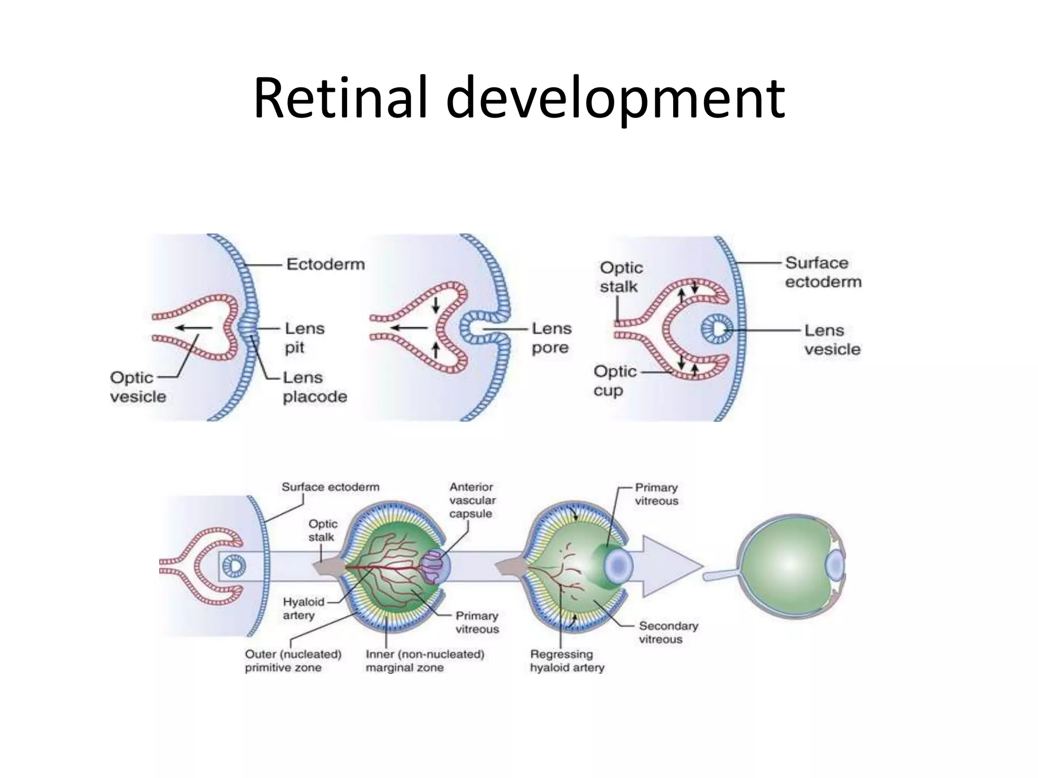 Retinopathy of prematurity | PPTX