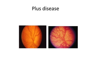 Retinopathy of prematurity | PPTX
