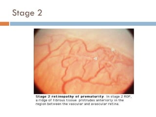 Retinopathy of prematurity | PDF