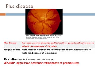 Retinopathy of prematurity | PDF