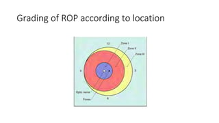 Retinopathy Of Prematurity.By Cynthia Oloo JKUAT student Bsc ...