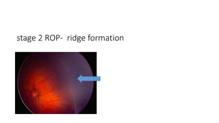 Retinopathy Of Prematurity.By Cynthia Oloo JKUAT student Bsc ...