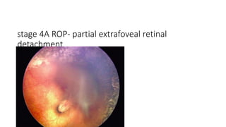 Retinopathy Of Prematurity.By Cynthia Oloo JKUAT student Bsc ...