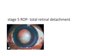 Retinopathy Of Prematurity.By Cynthia Oloo JKUAT student Bsc ...