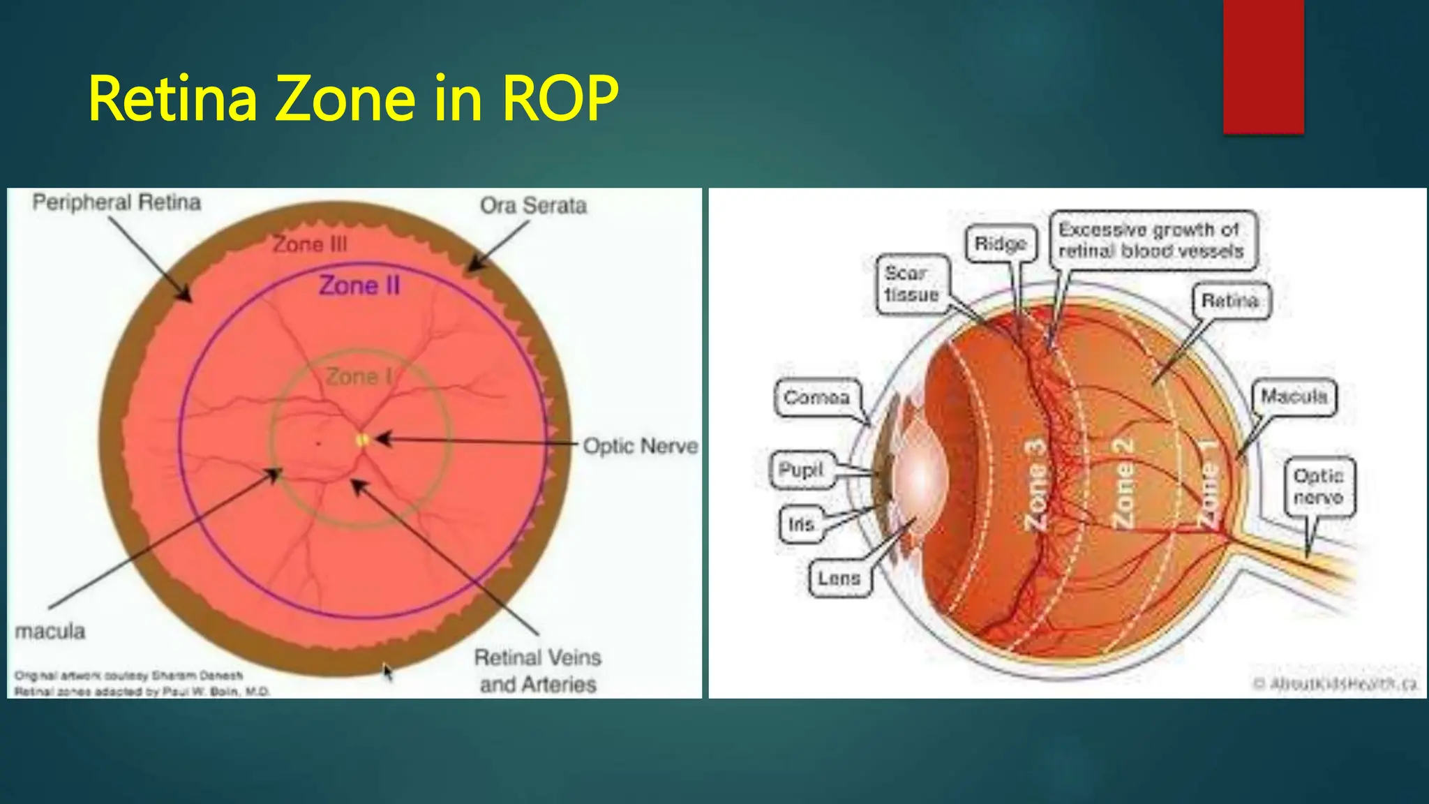 Retinopathy of prematurity for medical students.pptx